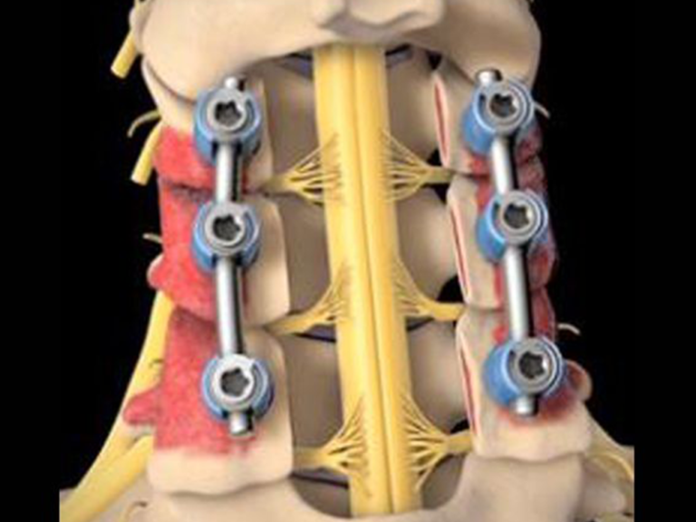 Spine Trauma Care Amritsar | Neuro Spine Clinic Amritsar