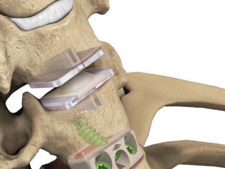 Posterior Cervical Fixation Lateral Mass – Rajkamal Neuro